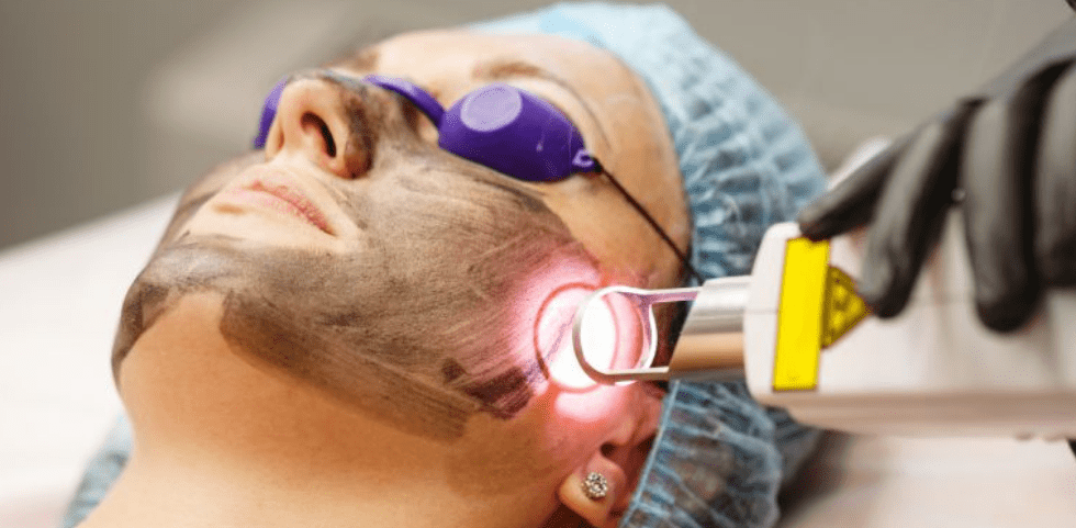 Effective Skin Laser Treatment for Pigmentation, tanning, fine lines ...